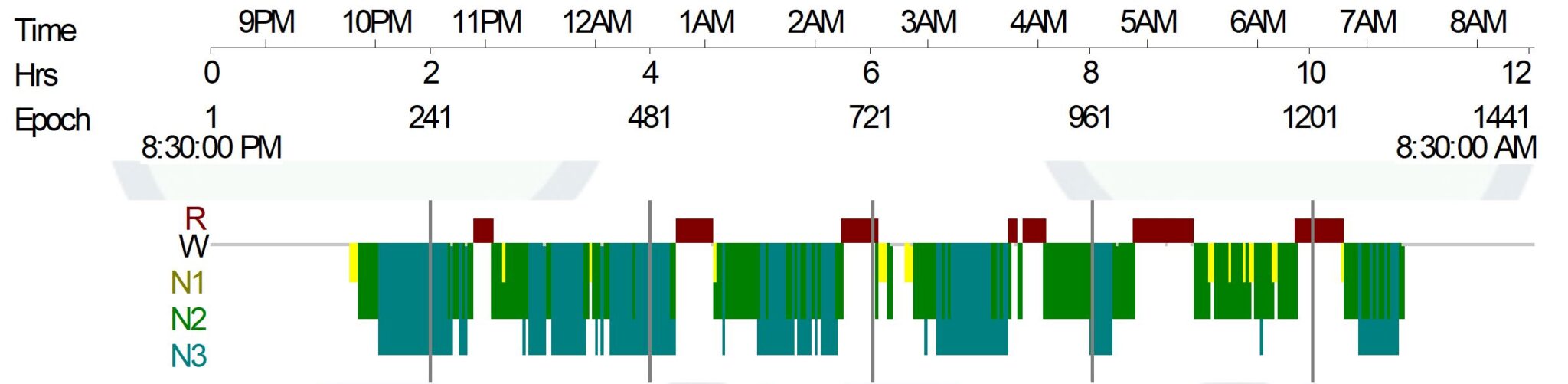 Obstructive sleep apnoea (OSA)- A multi system disease | RSDC